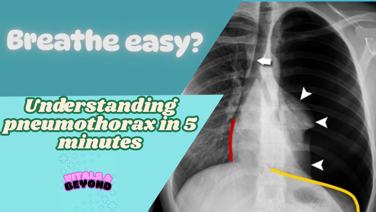 Pneumothorax Explained: Causes, Symptoms & Emergency Treatment - YouTube