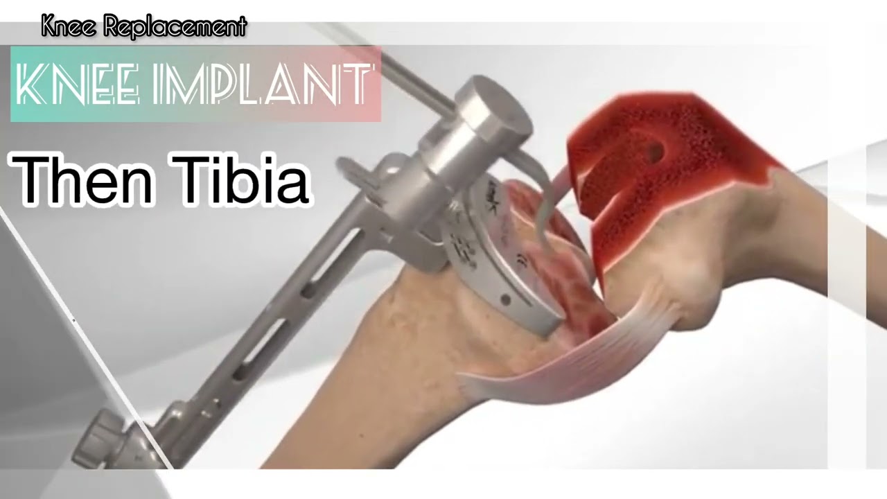 TKR 3D animation , knee replacement surgery - YouTube