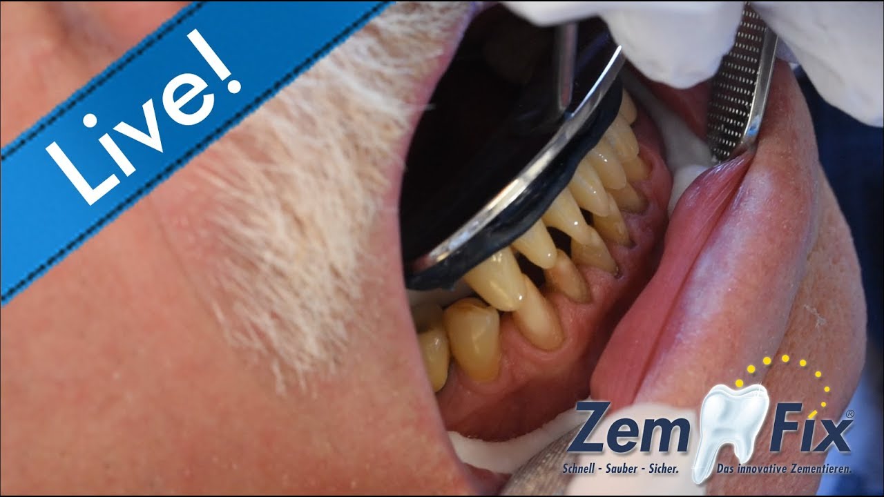 Six (6) anterior ceramic crowns inserted easily at once with ZemFix ...