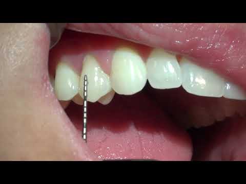 How to Measure Gingival Recession