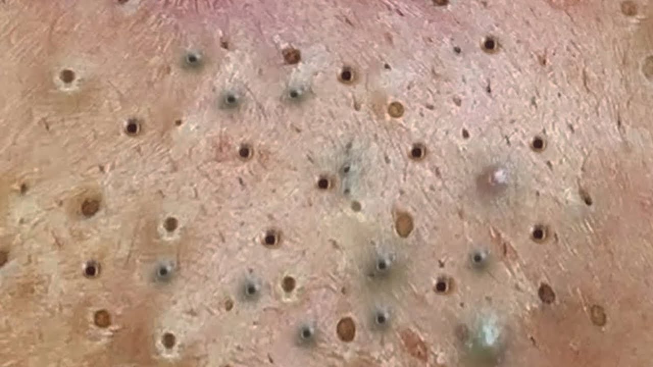 Amazing Acne Treatment (Blackheads and whiteheads removal) - Relaxing ...