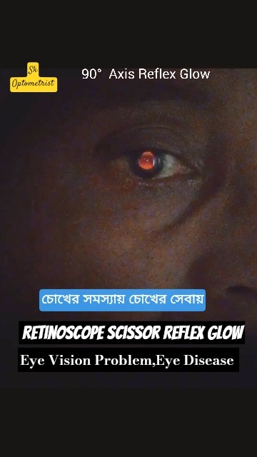RETINOSCOPE REFLEX GLOW|SCISSOR REFLEX IN EYE|KERATOCONUS|RETINOSCOPE ...