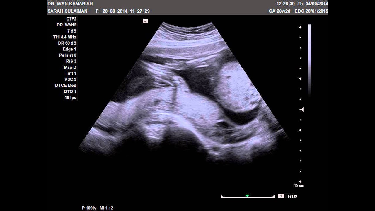 Scan 2D at 20 weeks 2 days Baby Z! - YouTube