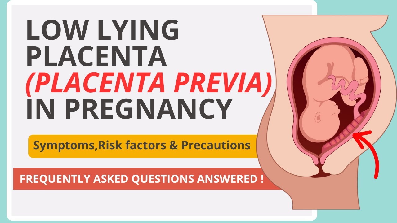 Low Lying Placenta (Placenta Previa) Explained: What Every Pregnant ...