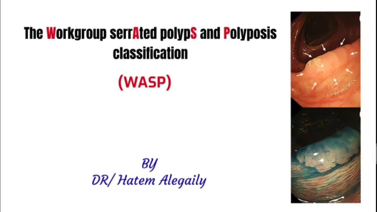 WASP Classification for Sessile serrated polyps - YouTube