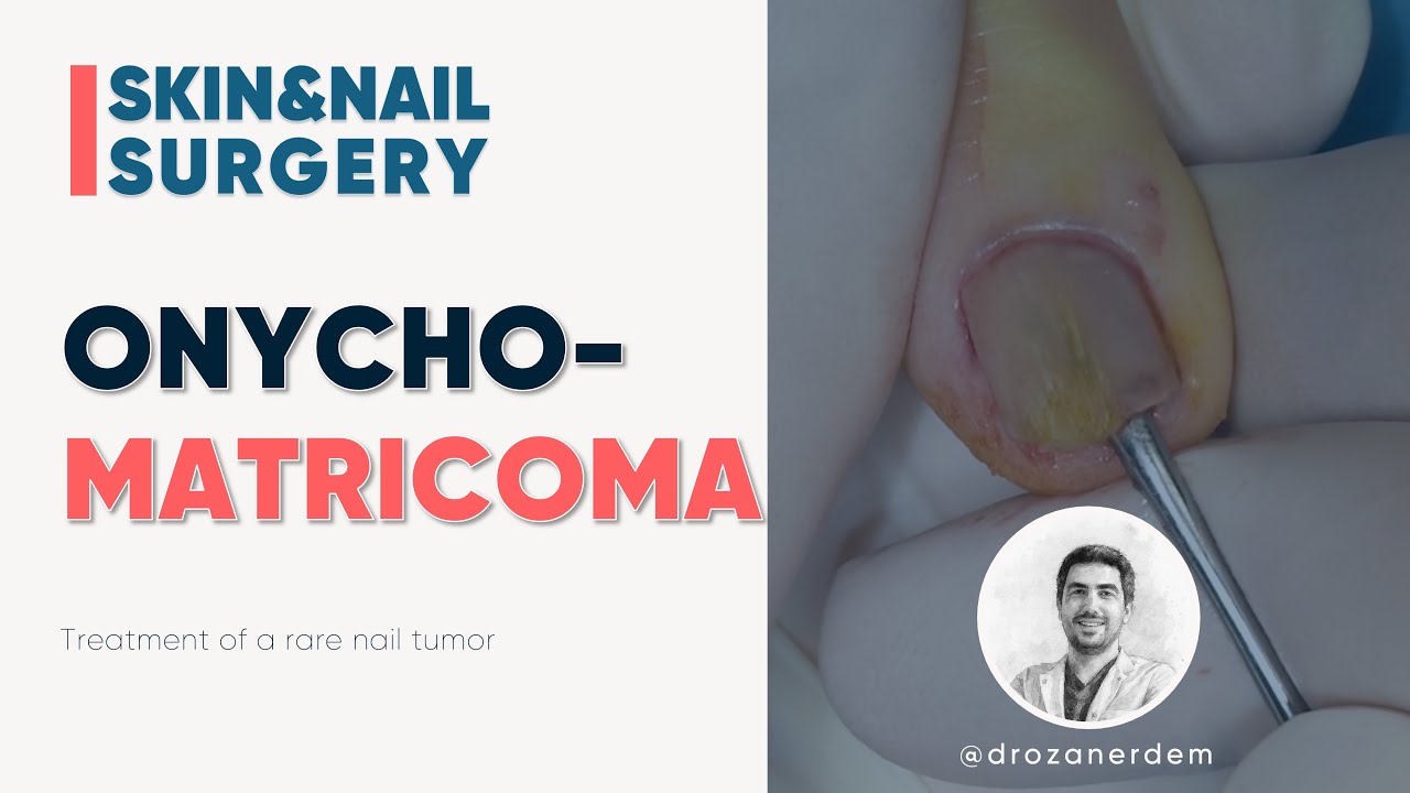 Onychomatricoma Excision: Surgical Treatment of a Rare Nail Matrix ...