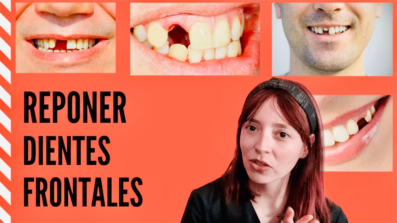 ¿Cómo reponer dientes frontales? 🤔 🦷 😷 - YouTube