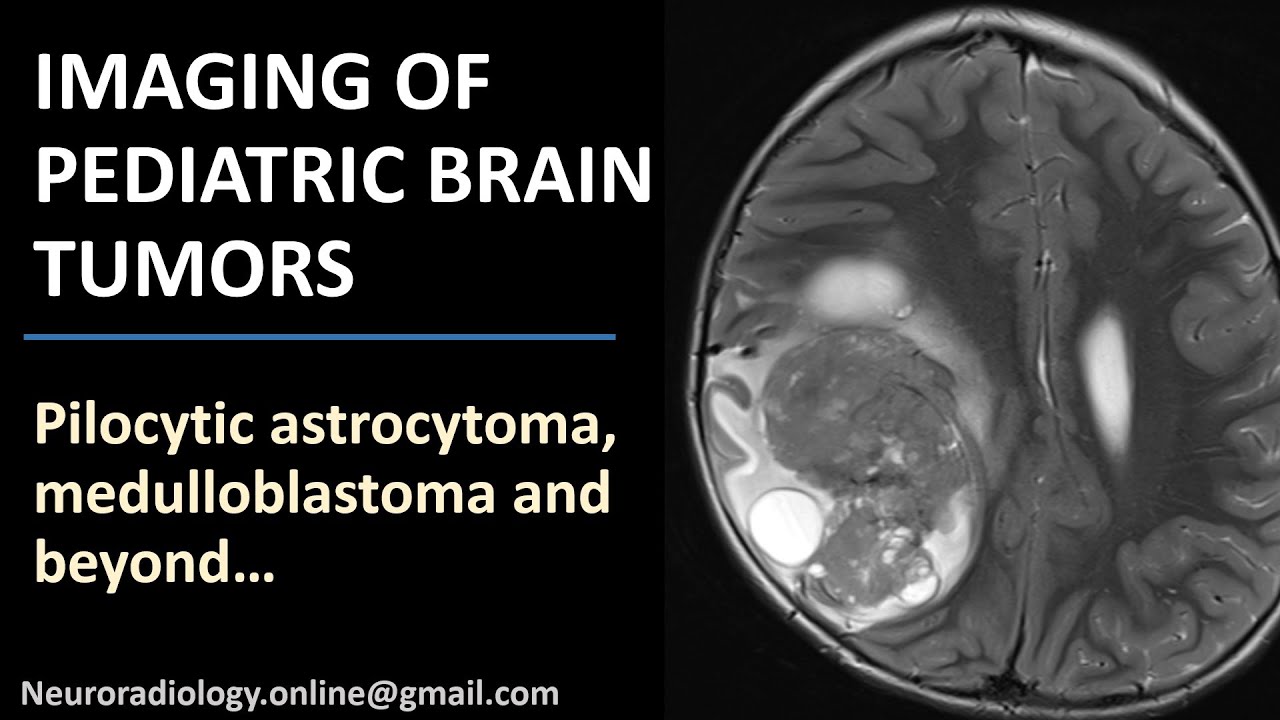 Imaging of Pediatric Brain Tumors - YouTube