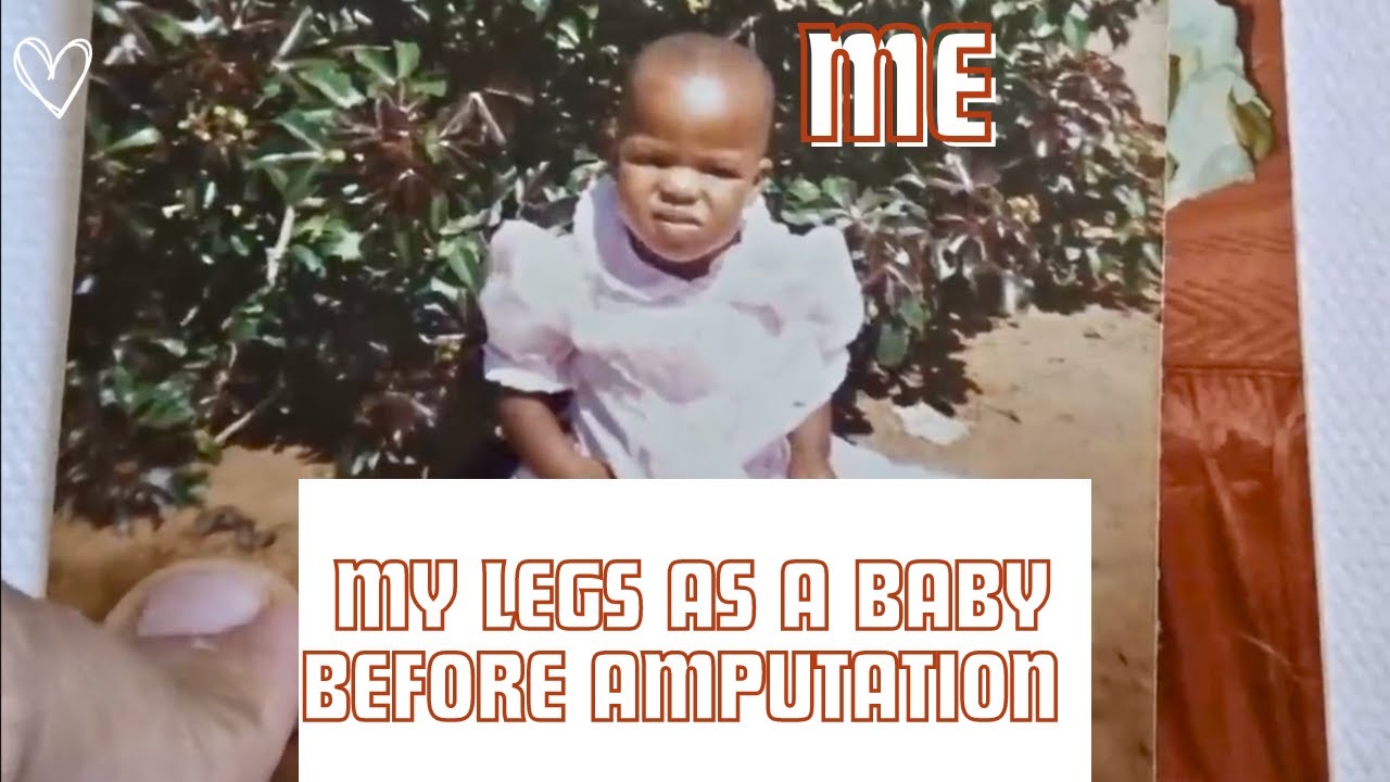 How my Legs Looked like before Amputation With Pictures - YouTube
