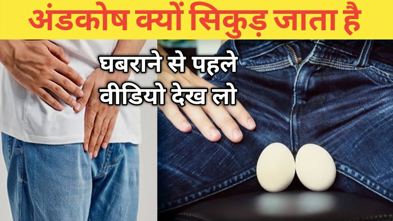 Andkosh sikud jana || andkosh chhota ho gaya hai || testis ka sikud ...
