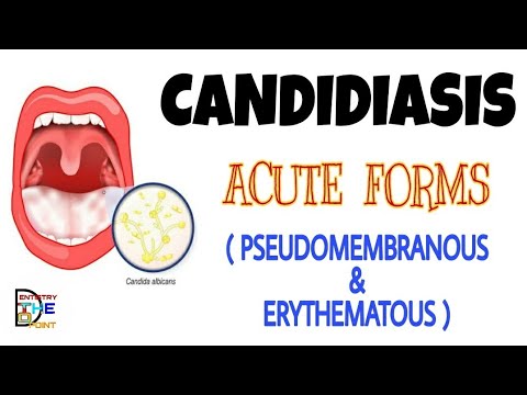 CANDIDIASIS ( ACUTE FORMS - PSEUDOMEMBRANOUS & ERYTHEMATOUS) - YouTube