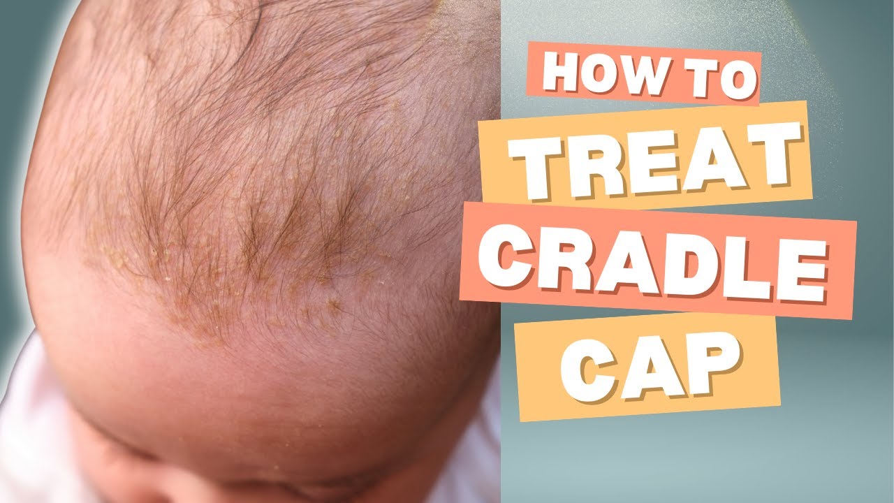 Cradle Cap Won't Go Away? Here's What Actually Works | NP Explains ...