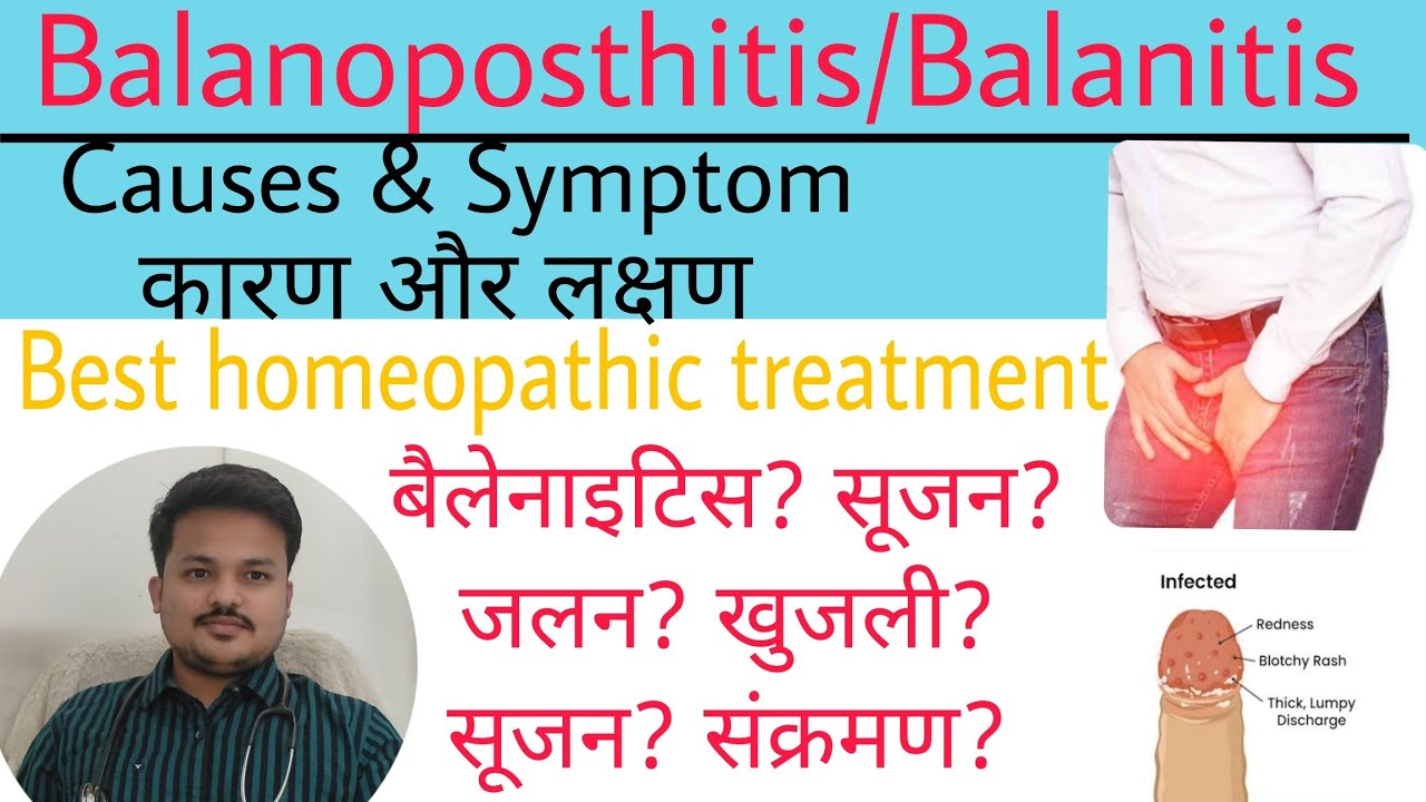 Balanitis/Balanoposthitis होम्योपैथीक Treatment क्या क्या कारण और लक्षण ...