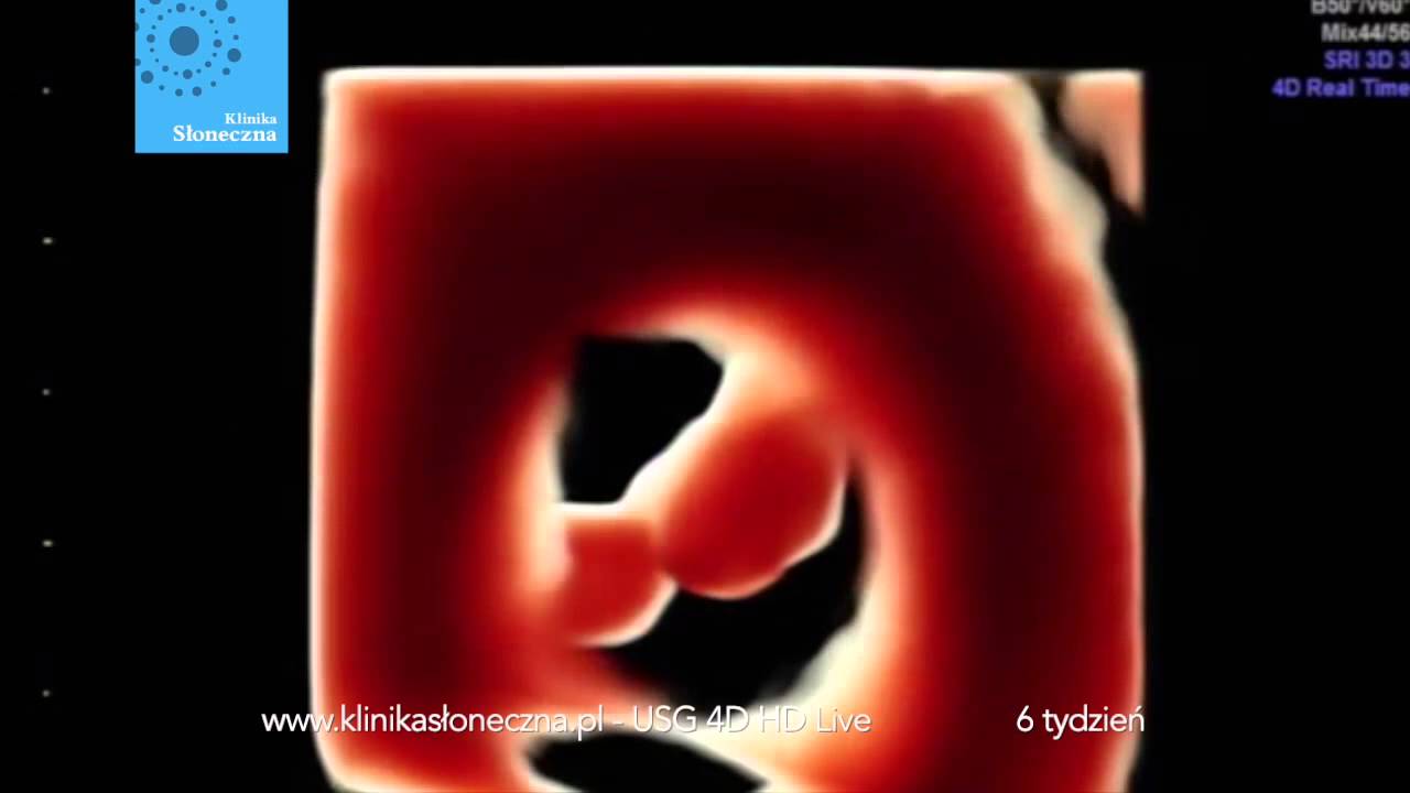 USG 4D HD Live - 6 tydzień ciązy - www.klinikasloneczna.pl Poznań - YouTube