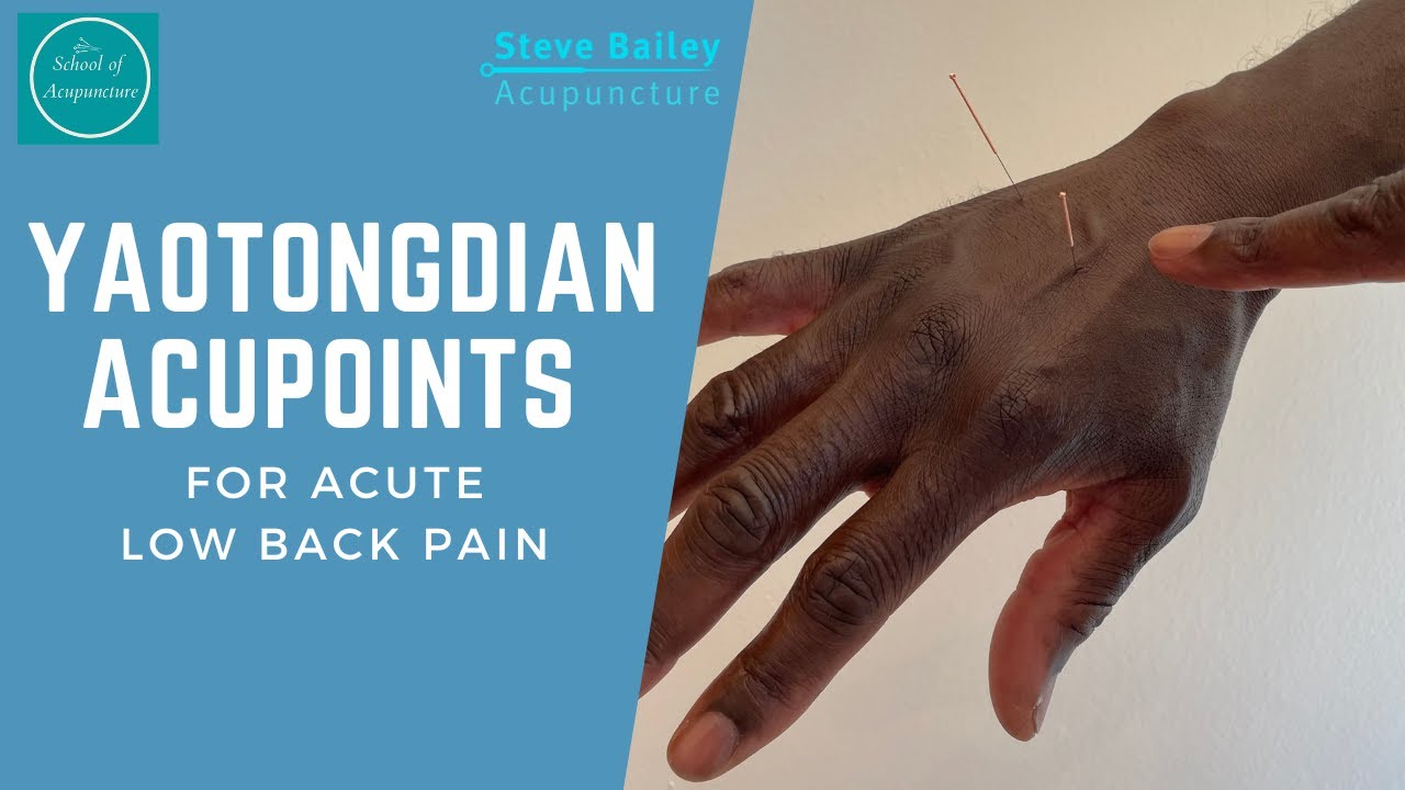 How to locate and needle Yaotongdian acupoint for acute low back pain ...