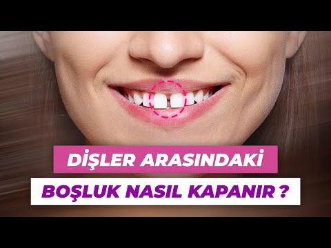 Dişler arasındaki boşluk nasıl kapanır?