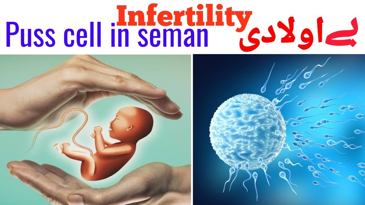 seminal infection,infertility, puss cells in semen. causes And ...