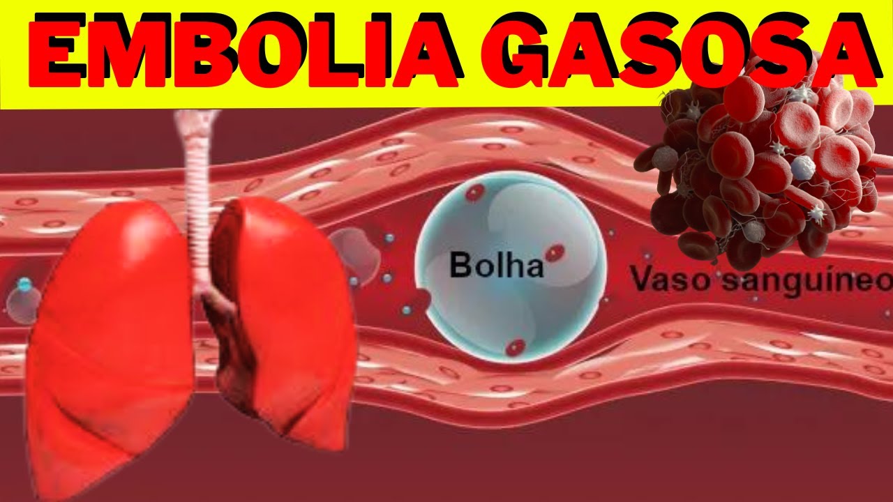 CAUSA DE MUITA MORTE: Ameaça Silenciosa Embolia Gasosa e os Perigos ...