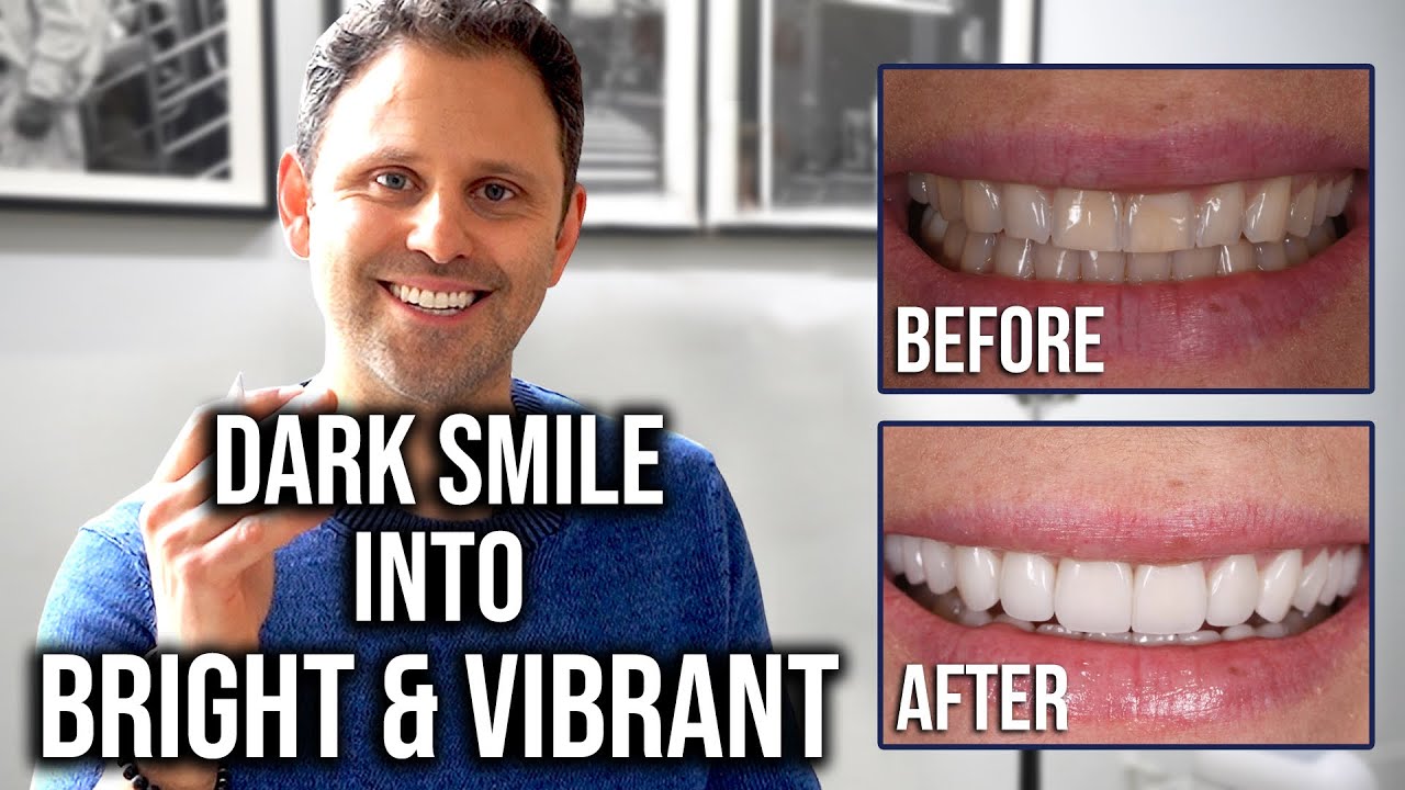 Using Porcelain Veneers To Create a Bright Smile - Dental Science - YouTube