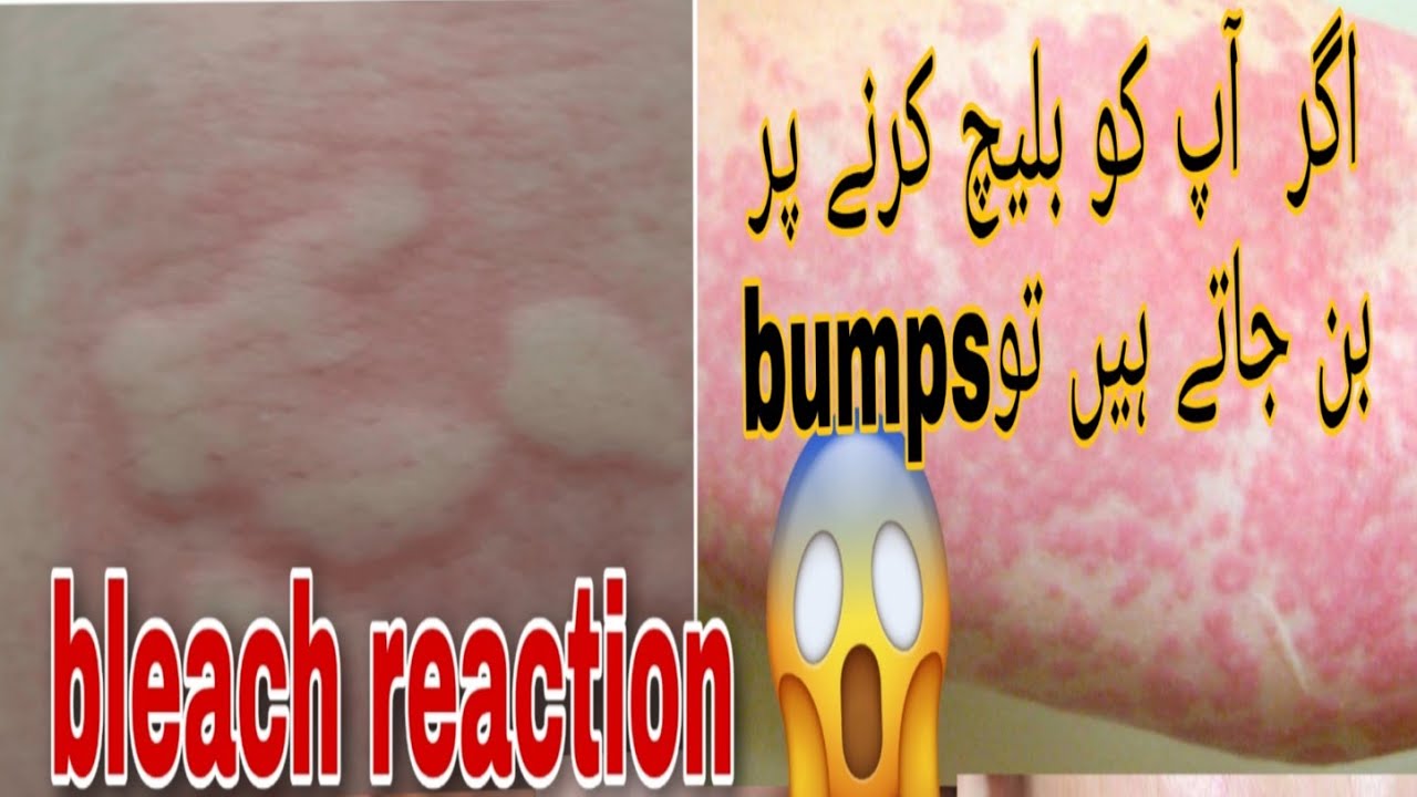 how to manage bleach reaction part 2|bleach bumps|groom up with nagina ...