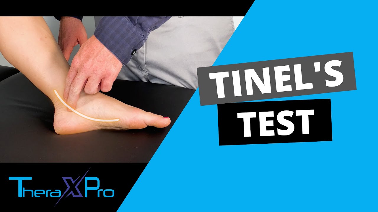 Tinel's Sign | Tarsal Tunnel Syndrome - YouTube