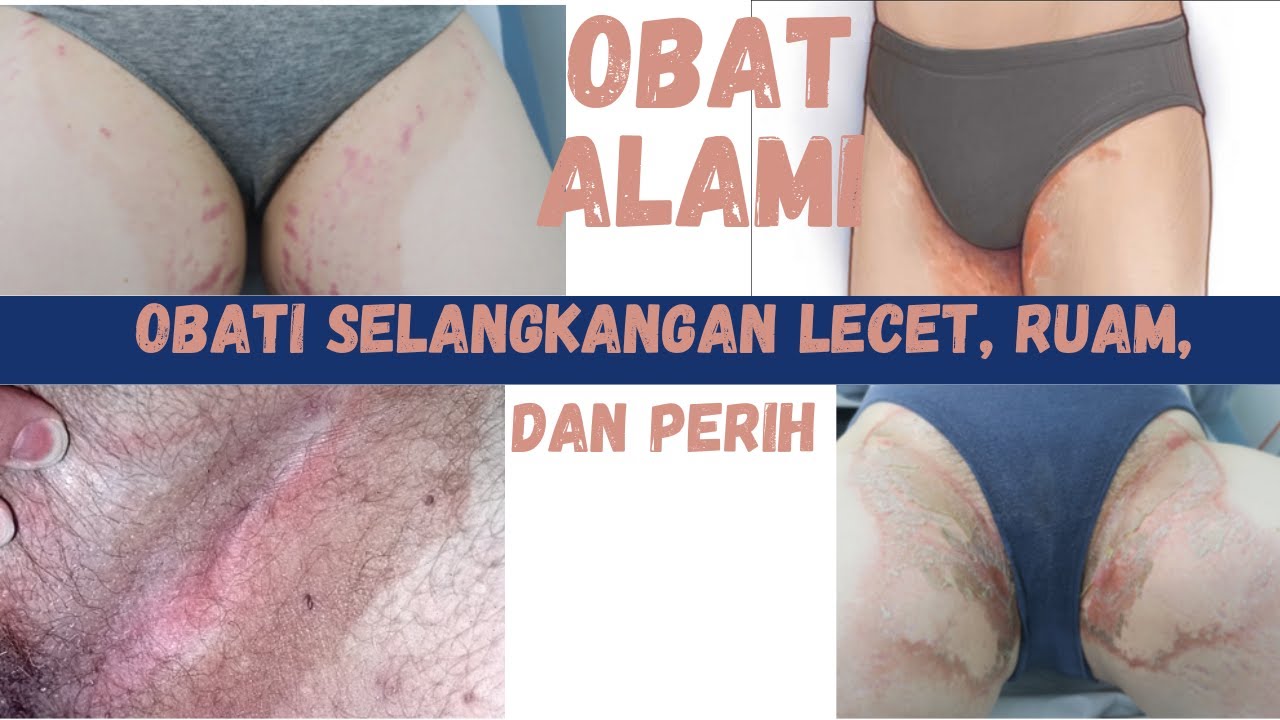 Obati Selangkangan Lecet, Ruam, dan Perih – Penyebab, Gejala, dan Solusi Ampuh - YouTube