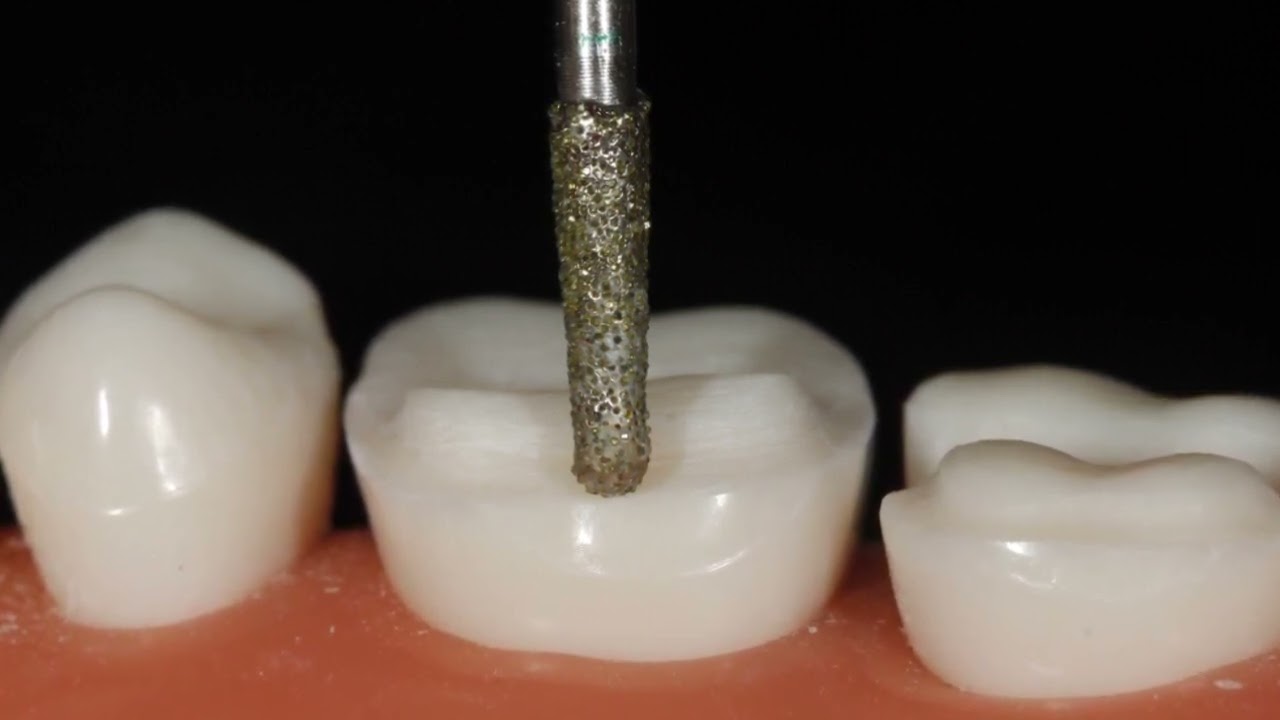Preparaciones para Onlays - YouTube