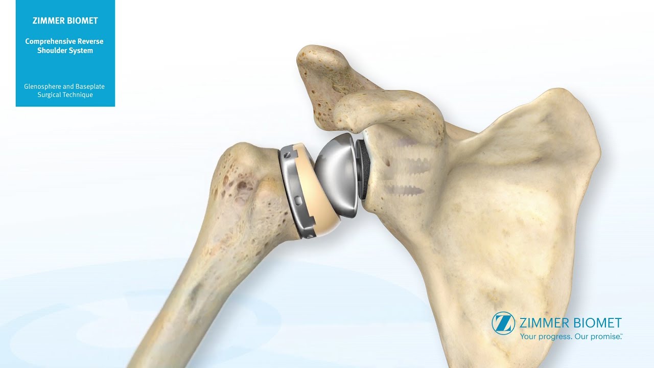 Comprehensive Reverse Shoulder System -ZimmerBiomet - YouTube