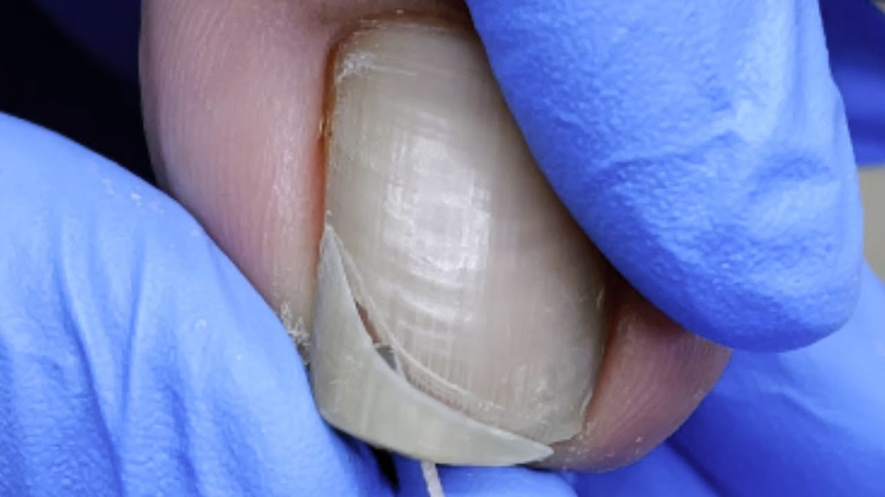 Pedicure Tutorial: Very Long Toenails, Seriously Inset【Pedicure Master ...