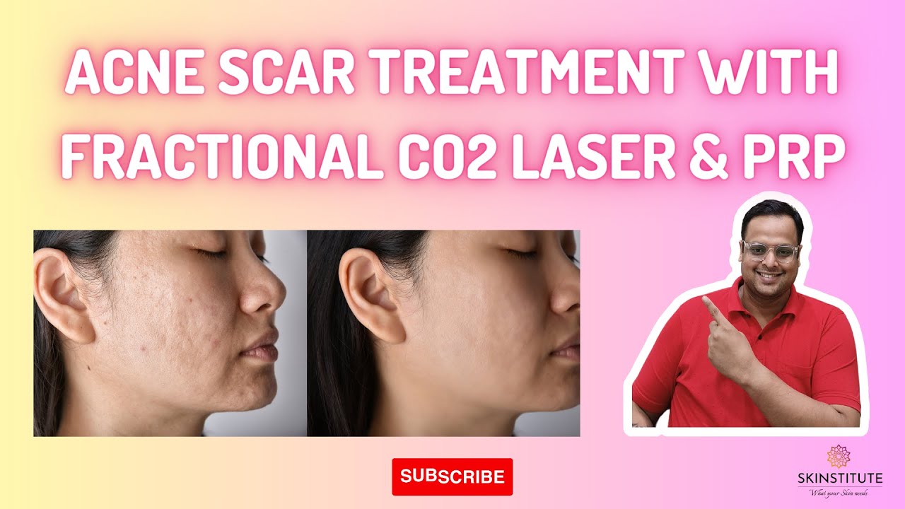 Fractional CO2 laser and Platelet Rich plasma in Acne scars treatment ...