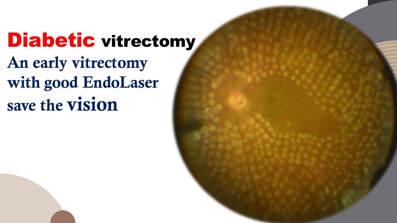Diabetic vitrectomy - An early vitrectomy with good EndoLaser save the ...