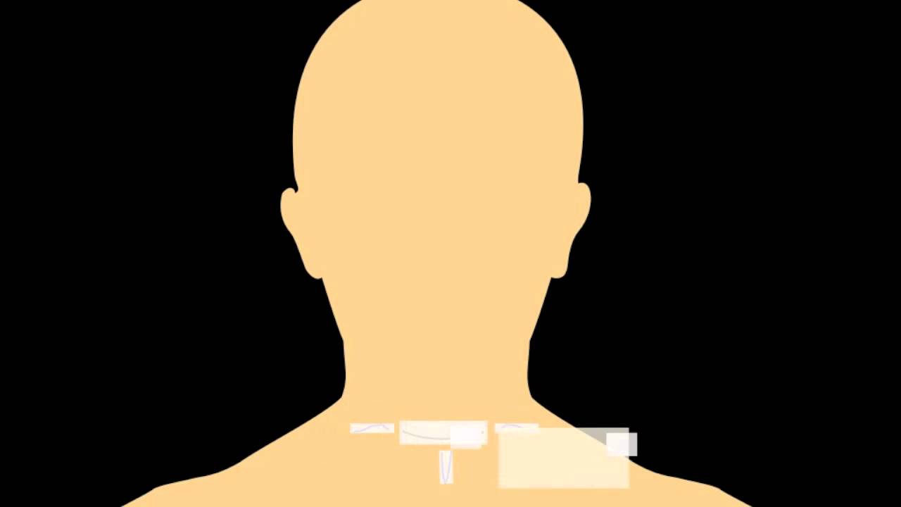 How to remove prolene stitch.mov - YouTube