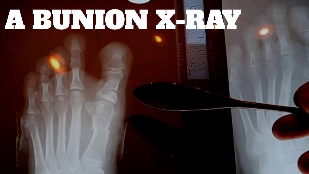AN X RAY BREAKDOWN OF A BUNION - YouTube