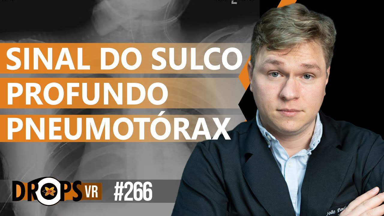 SINAL DO SULCO PROFUNDO - IDENTIFICANDO PNEUMOTÓRAX - YouTube
