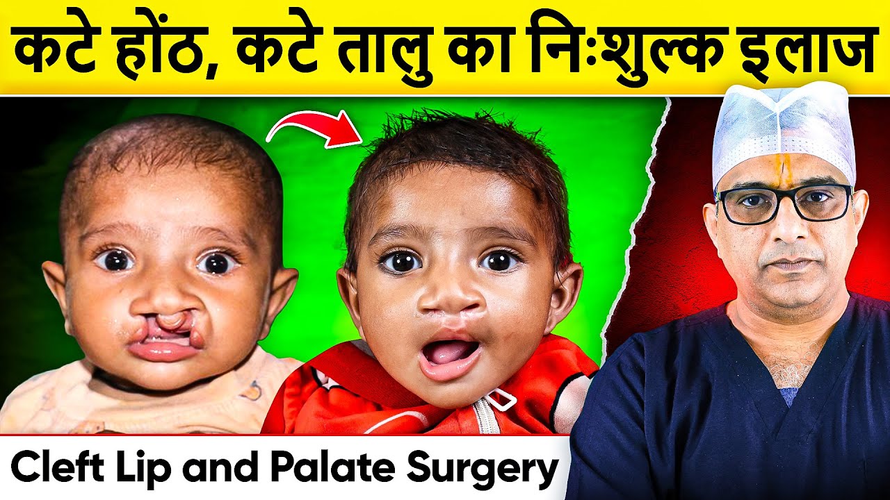 Cleft Lip and Palate Before & After Surgery at Saraswat Hospital Agra ...