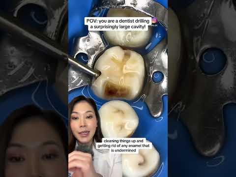 Uncovering a surprisingly large cavity! #cavity #drilling #dentist #bigcavity