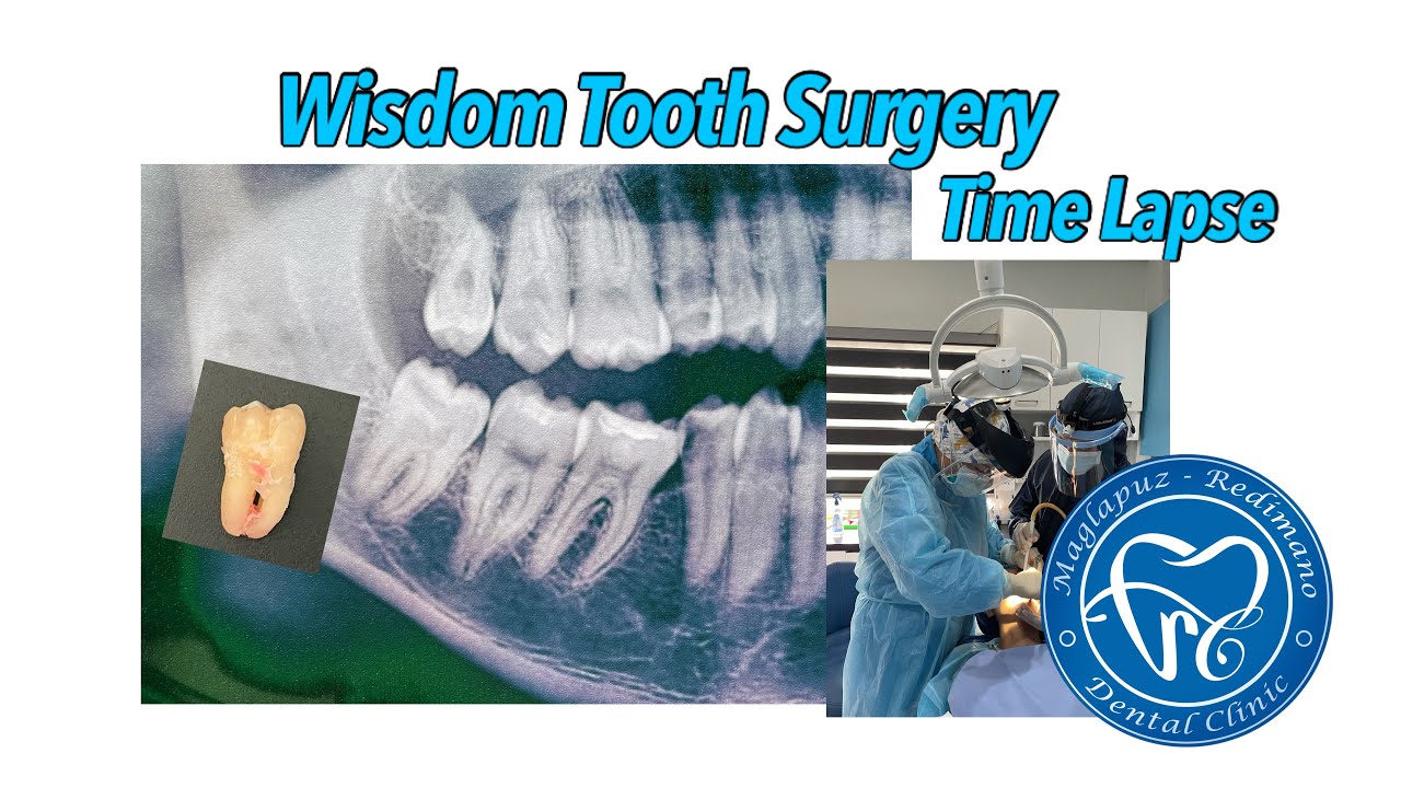TIME LAPSE | WISDOM TOOTH SURGERY | DR. MARA REDIMANO - YouTube