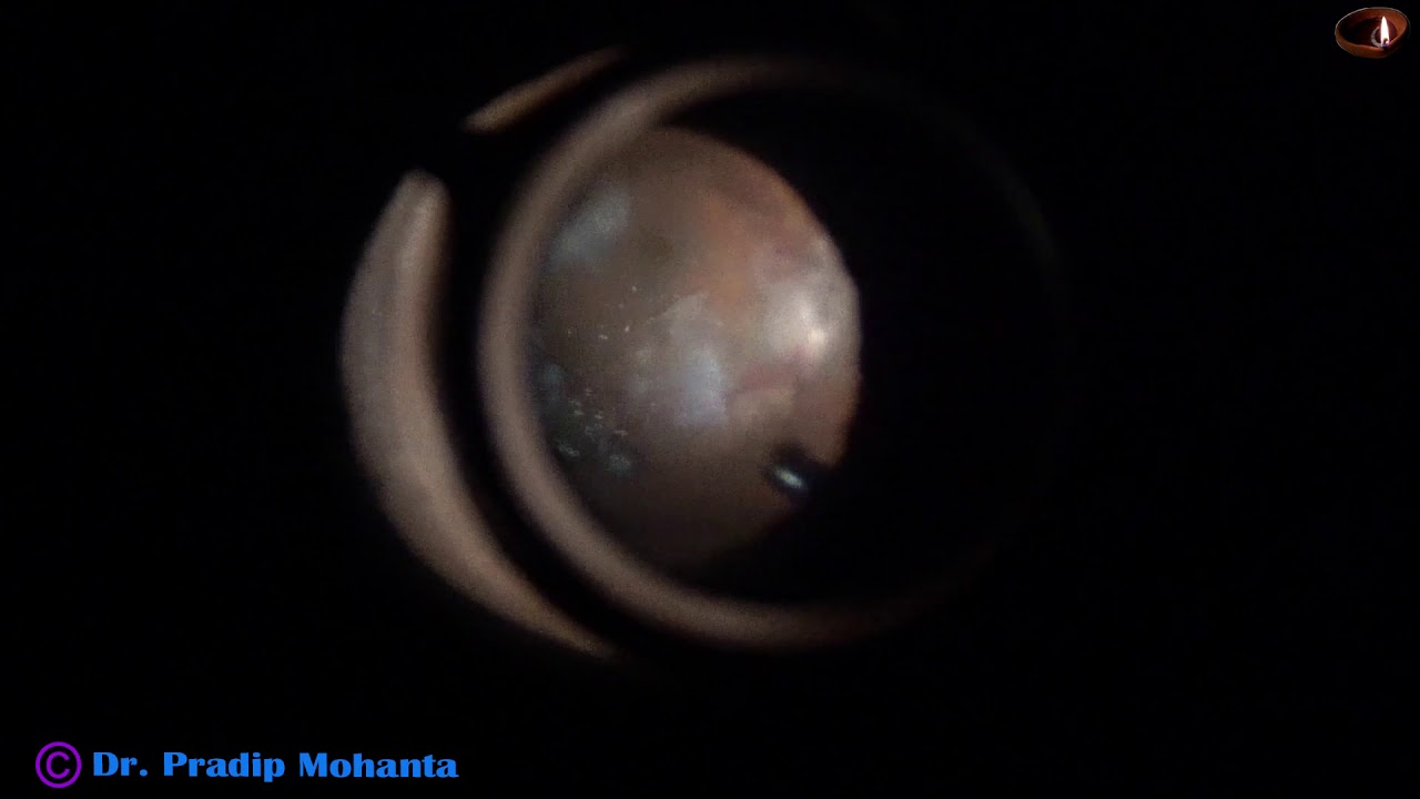 Management of a whole NUCLEUS DROP : Pradip Mohanta, 26/07/2019 - YouTube