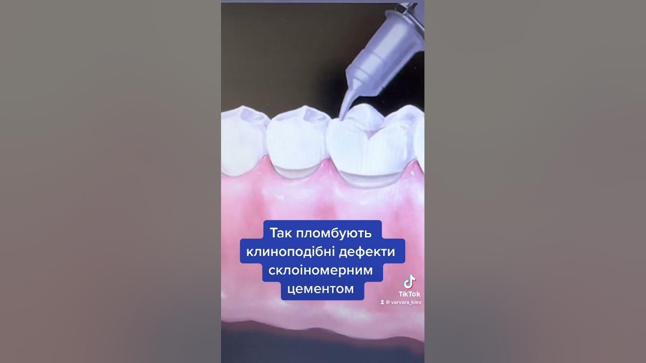 Закрытие клиновидных дефектов стеклоиномером - YouTube