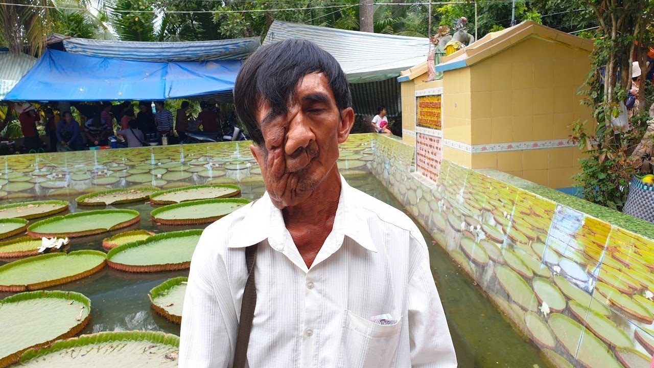 Người đàn ông bị bứu ăn hết khuôn mặt lại xui xẻo bị kẻ xấu giật vé số ...