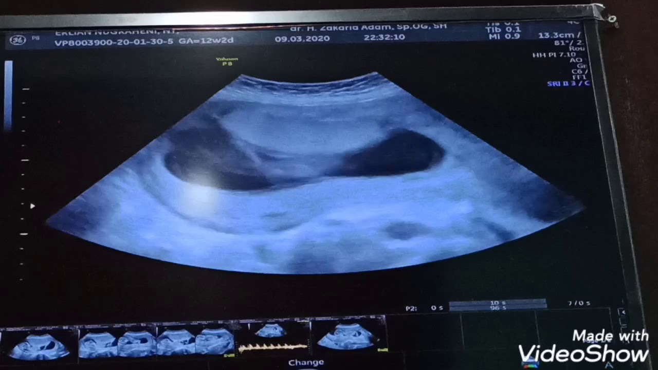 USG Bayi Kembar 12 Minggu - YouTube