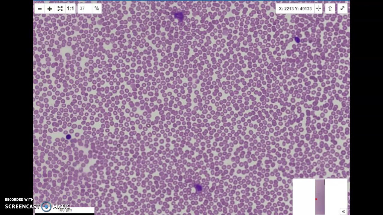 Platelet Satellitism - YouTube