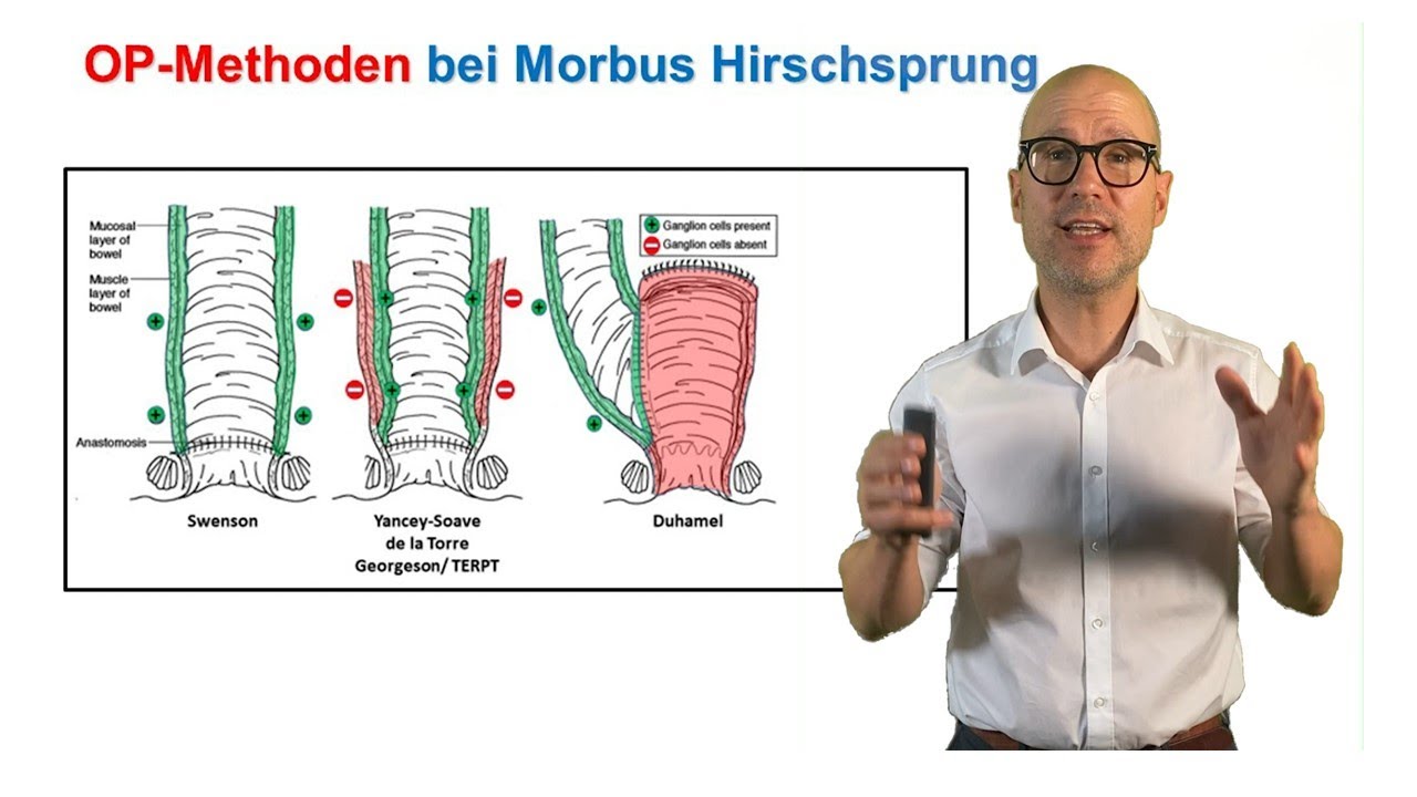 Morbus Hirschsprung - welche OP-Methoden gibt es ? - YouTube