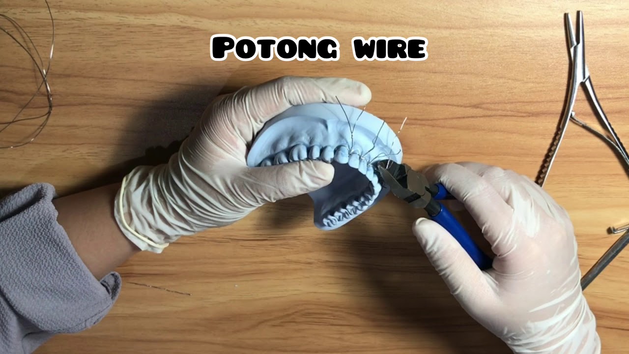 Splinting Essig & Stout (Indah Vitasari/1702551010) - YouTube