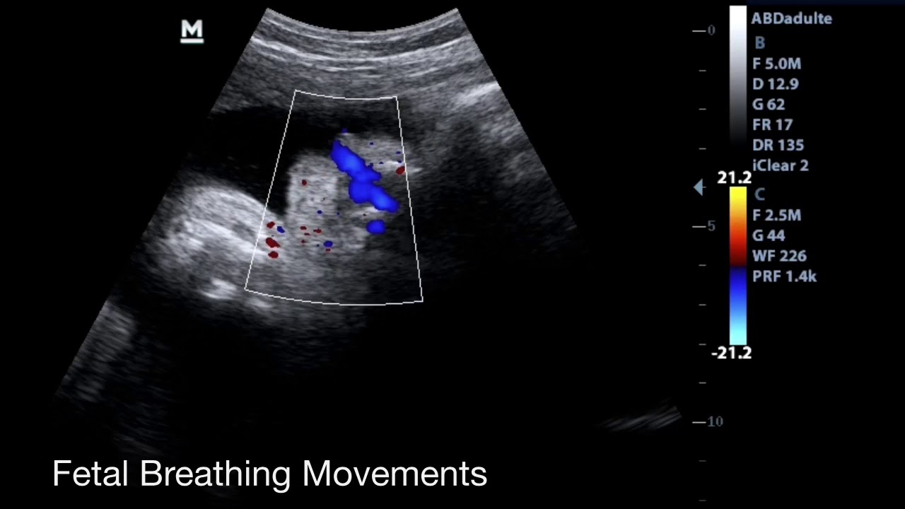 Fetal Breathing Movements - YouTube