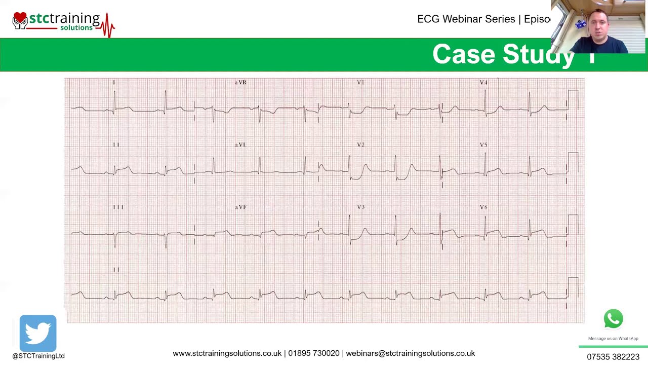ECG Webinar Series | Episode 5 | The T-Wave - YouTube