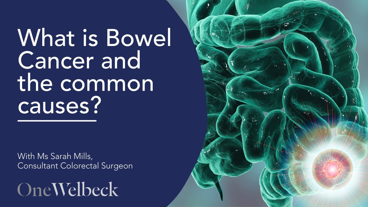 What is Bowel Cancer, what causes it and how can I help prevent it ...