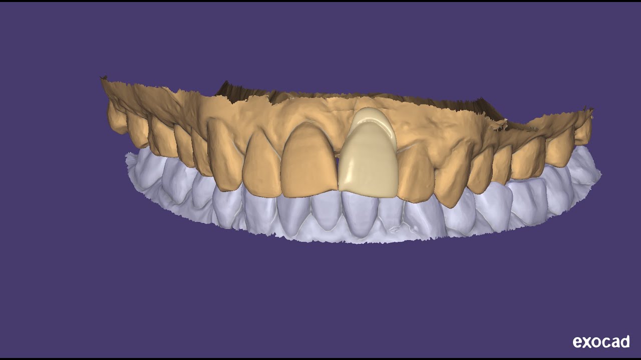 Upper anterior designing (copy teeth) for durable prosthesis in Exocad ...