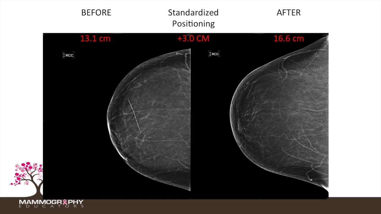 Volpara Solutions Technologist Training Amy Chatten RSNA 2018 - YouTube