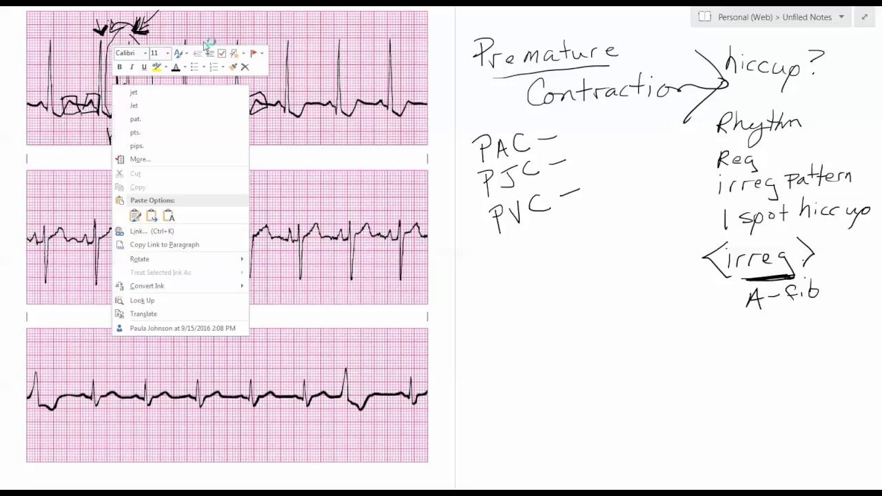 Premature contractions - YouTube
